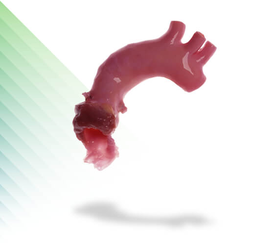 CryoValve® Aortic Allograft - Artivion