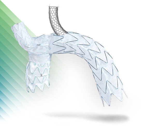 NEXUS DUO™ Aortic Arch Stent Graft System - Artivion